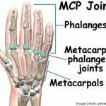 What You Should Know About Metacarpophalangeal Joint Pain?