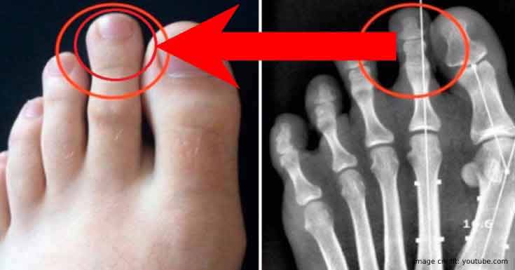 Mallet Toe: What You Really Need to Know About Mallet Toe?