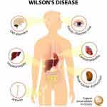 Polyarthritis: Symptoms, Causes, Treatments and More