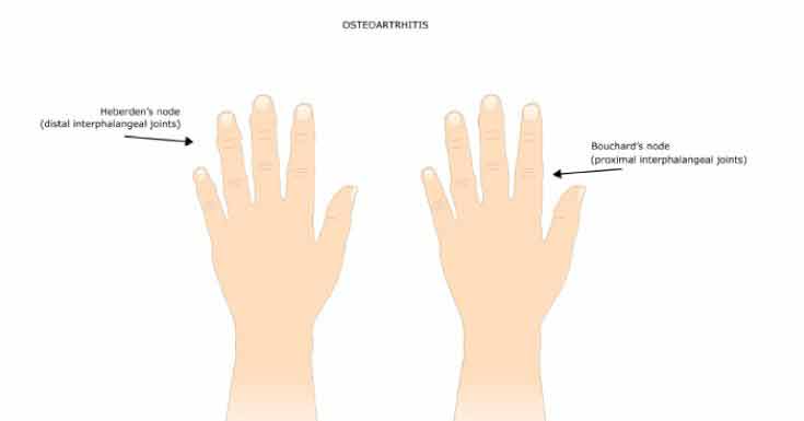 Psoriatic Arthritis - Symptoms, Causes, Treatment & More