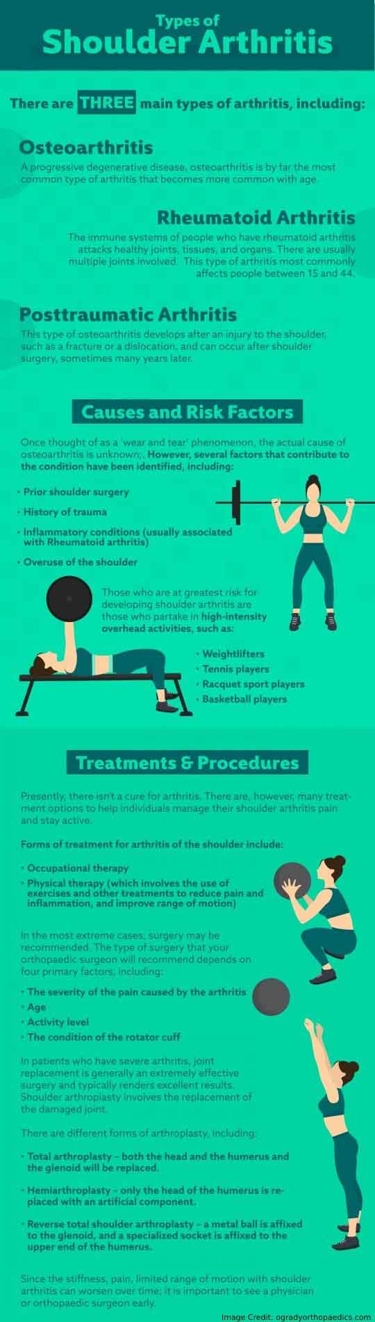 Shoulder Arthritis - Symptoms, Causes, Signs, and Treatment